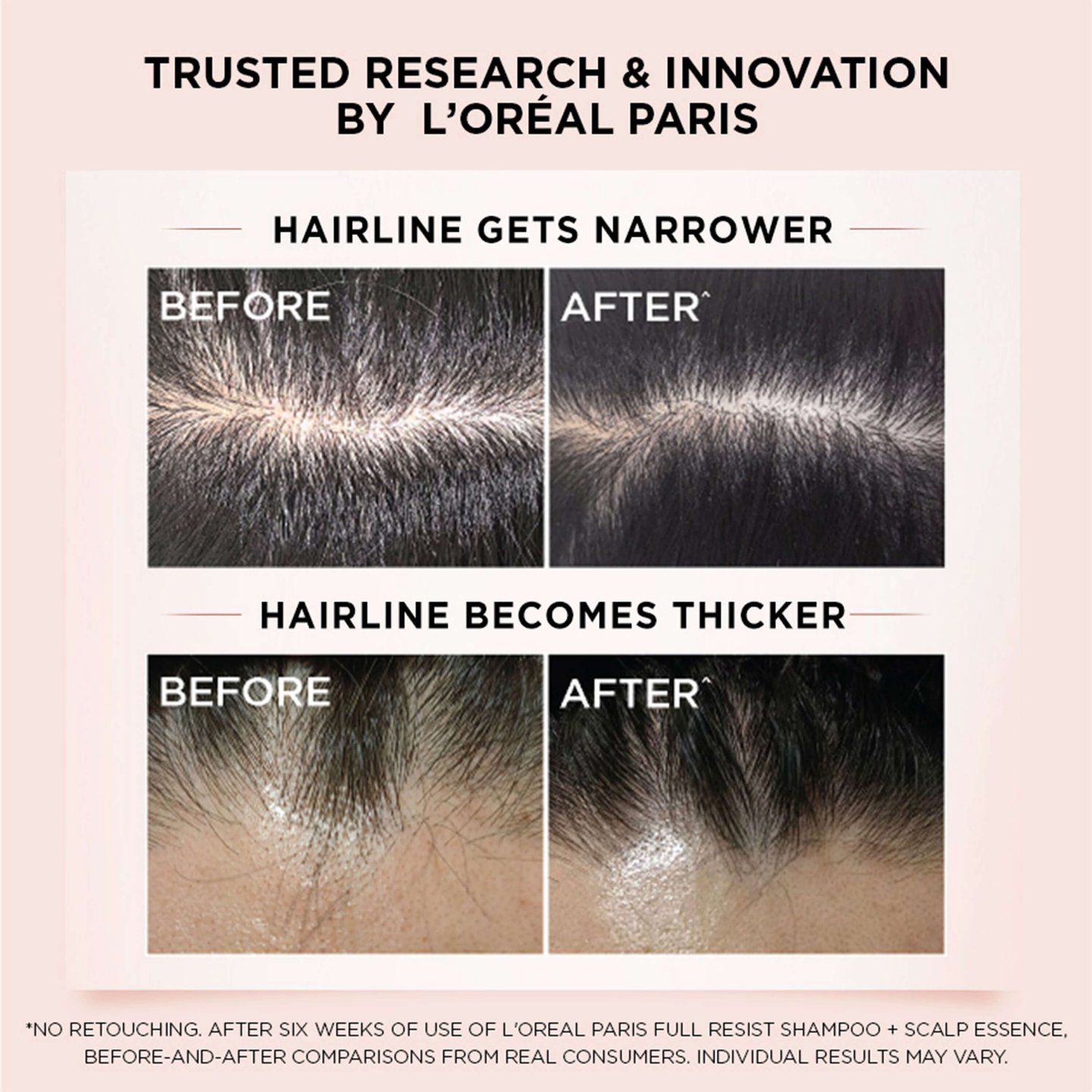 Elseve Anti Hair Fall Scalp Essence | L’Oréal Paris Singapore